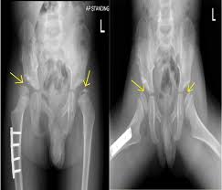 Legg-Calvé-Perthes Disease - Legg-Calvé-Perthes Disease